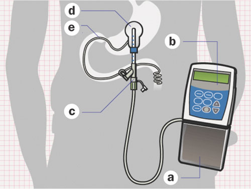 Bomba de infusión de Levodopa - UDIC Unitat D'Investigació Clínica